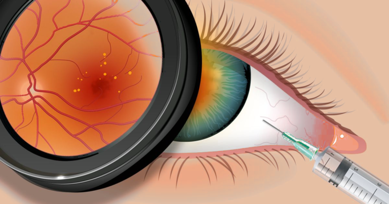 Intravitreal Eye Injection | An Innovative A.M.D. Treatment