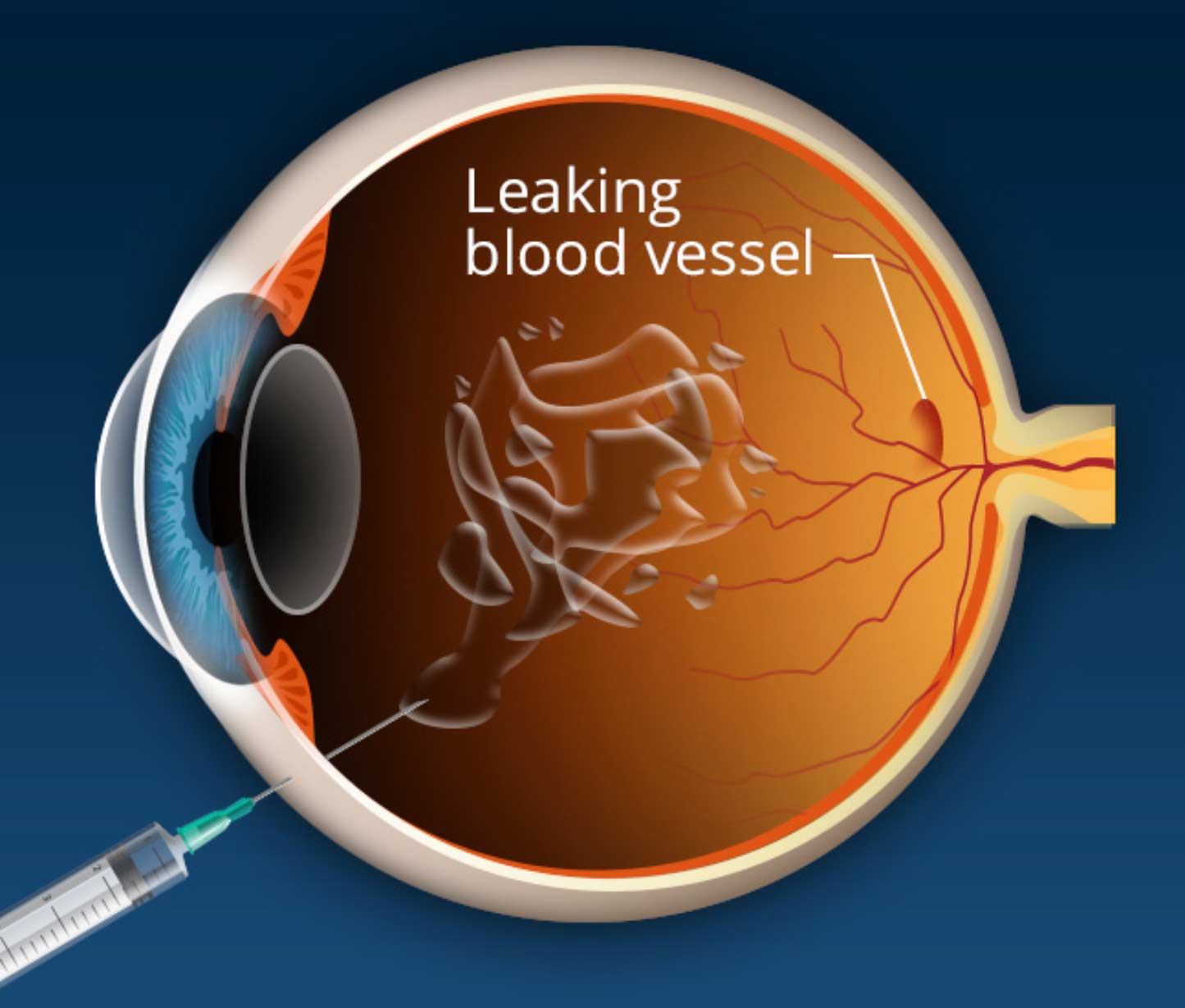 Intravitreal Injections 101 What You Need To Know